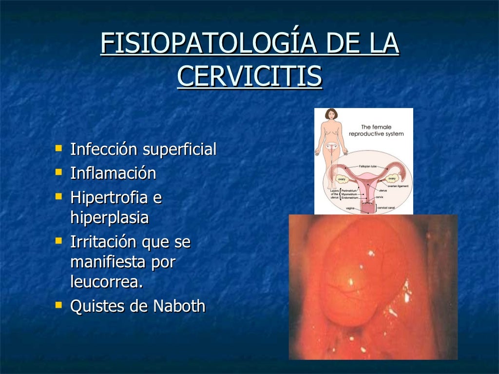 Cervicitis polipos