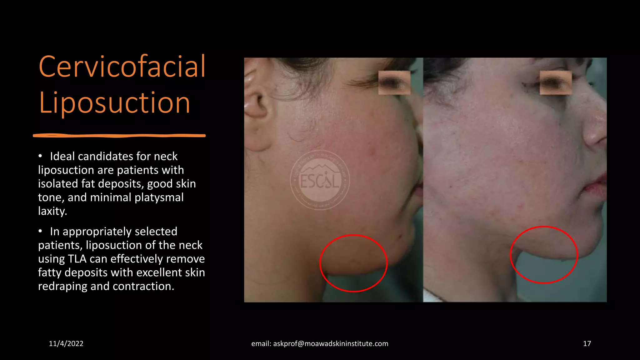 Cervicofacial Liposuction.pptx