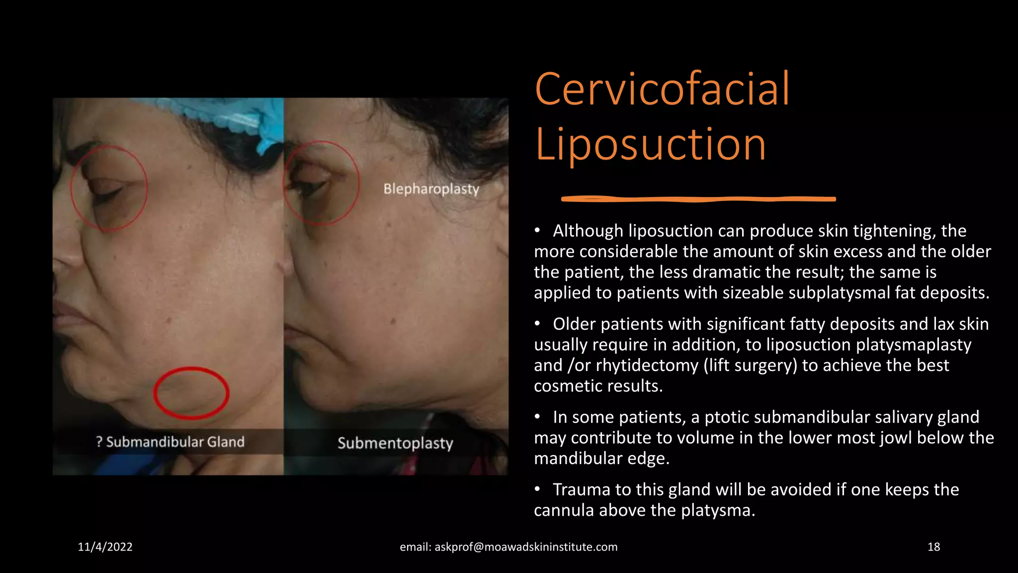 Cervicofacial Liposuction.pptx