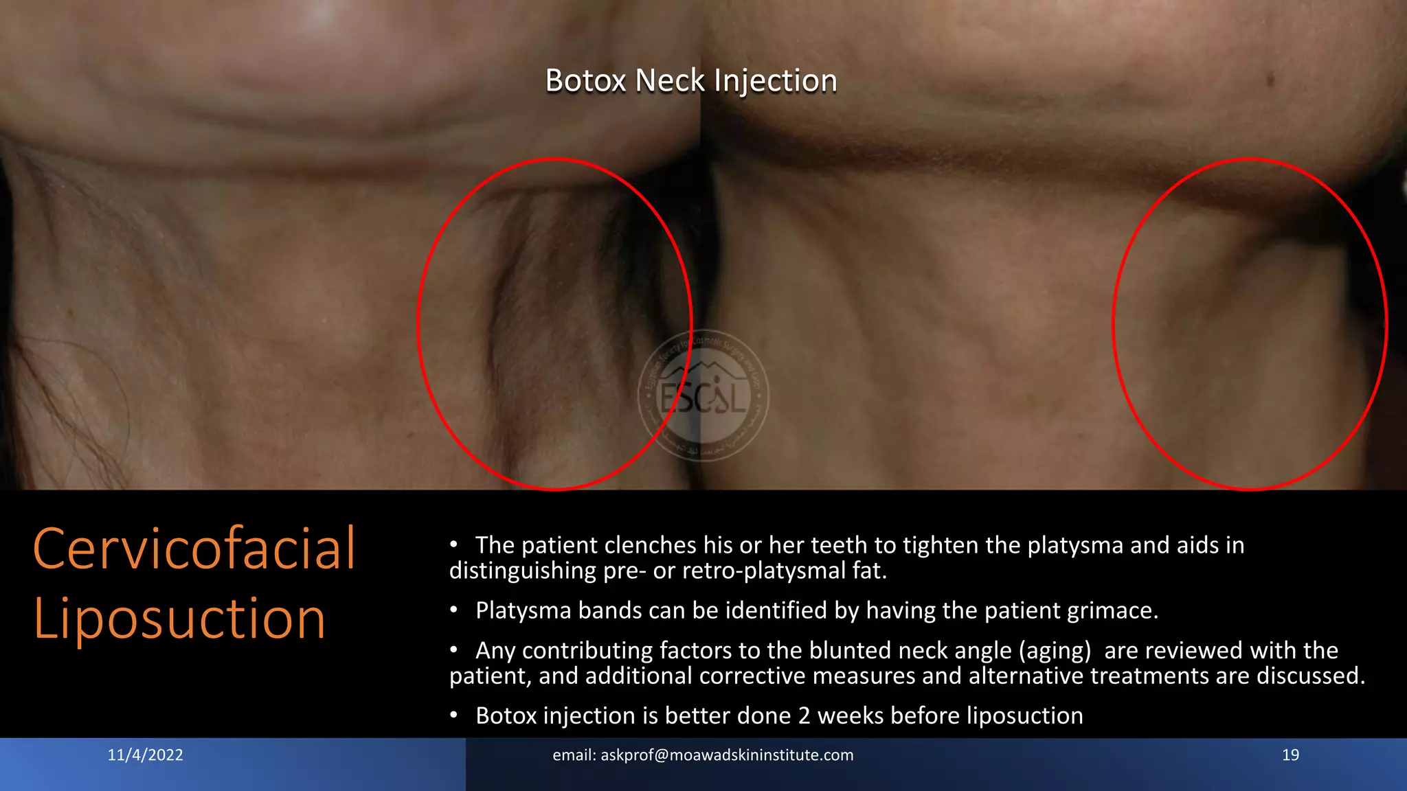 Cervicofacial Liposuction.pptx