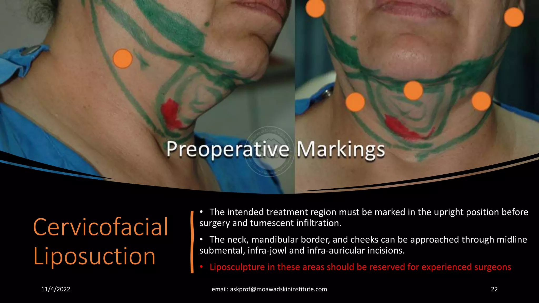 Cervicofacial Liposuction.pptx
