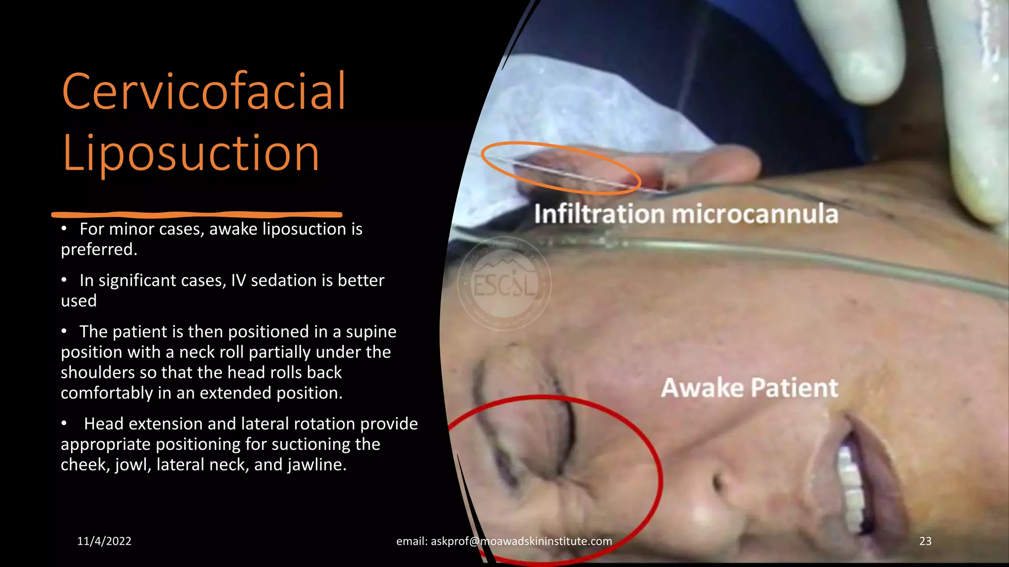 Cervicofacial Liposuction.pptx