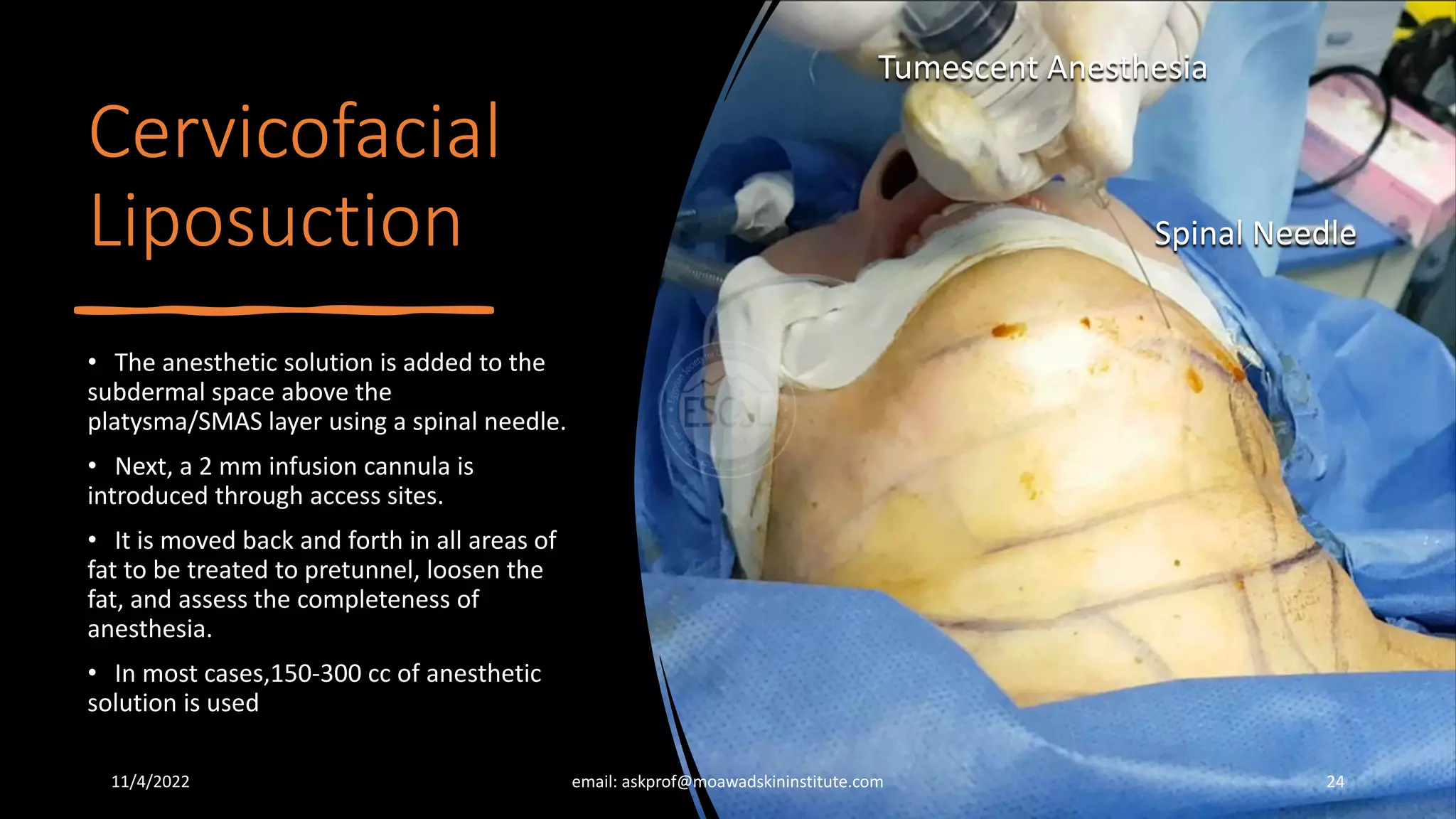 Cervicofacial Liposuction.pptx