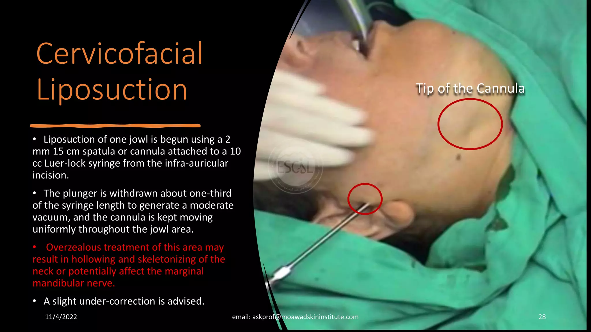Cervicofacial Liposuction.pptx