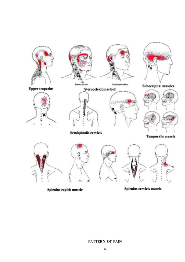 Cervicogenic headache | DOCX | Brain and Nervous System Disorders ...