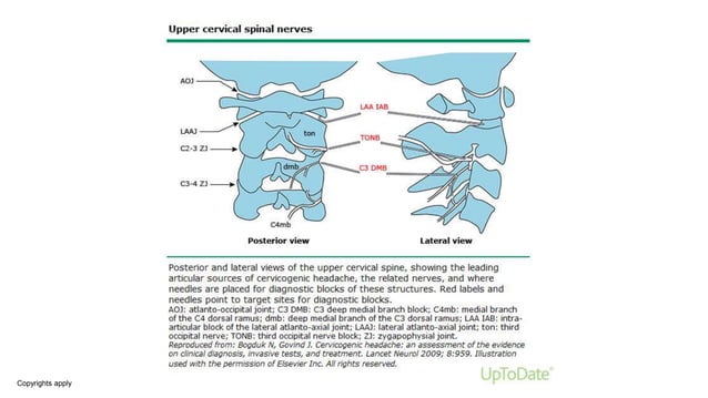 Cervicogenic Headache Following Lower Cervical RF Neurotomy | PPTX
