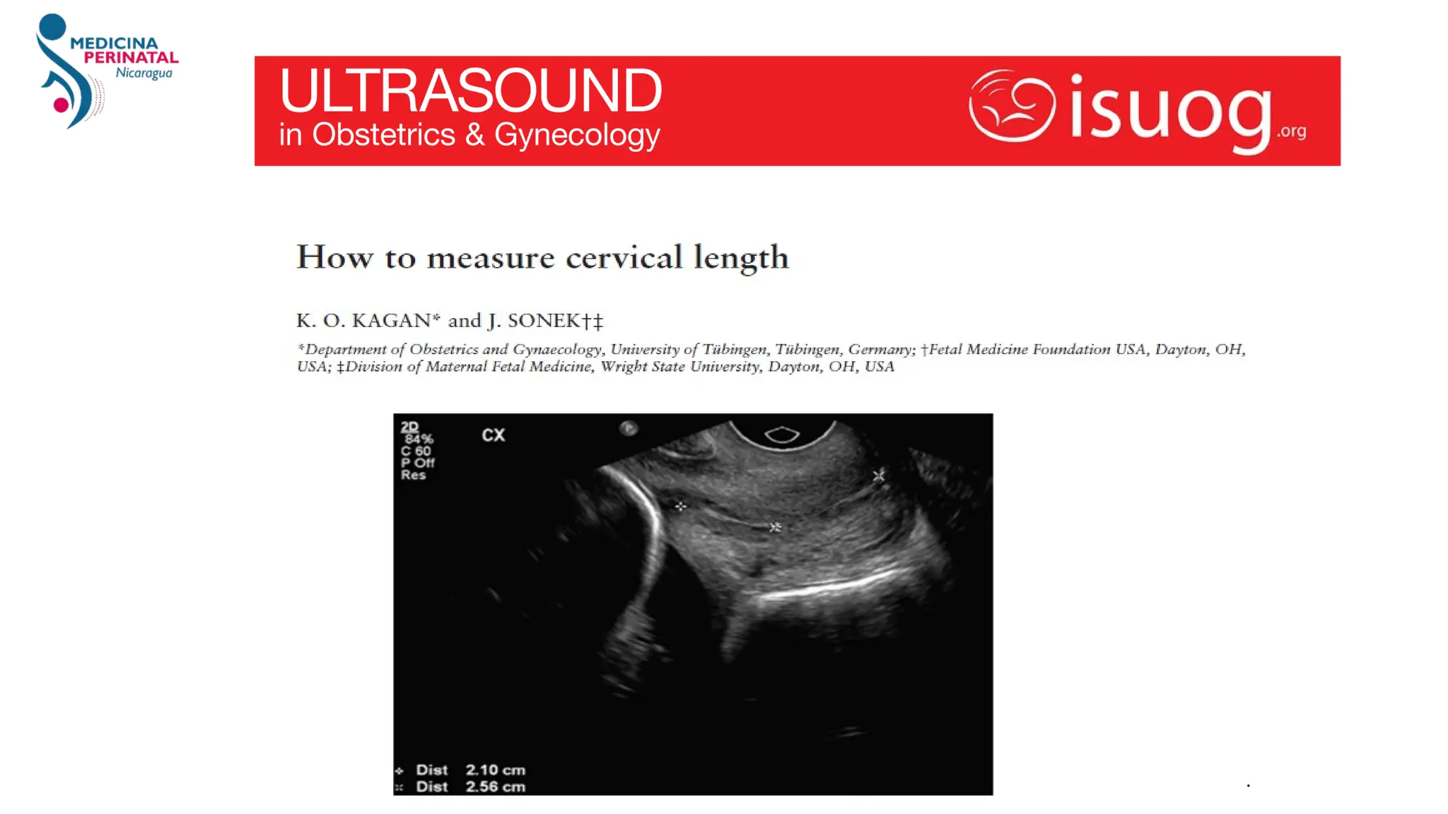 Cervicometría o longitud cervical examen radiologico de importancia en ...