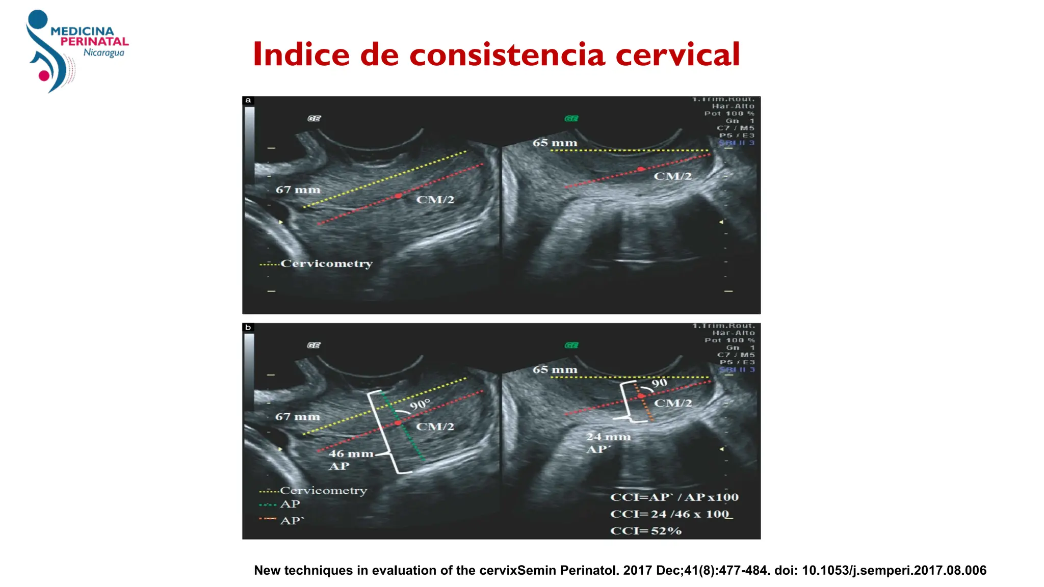 Cervicometría o longitud cervical examen radiologico de importancia en ...