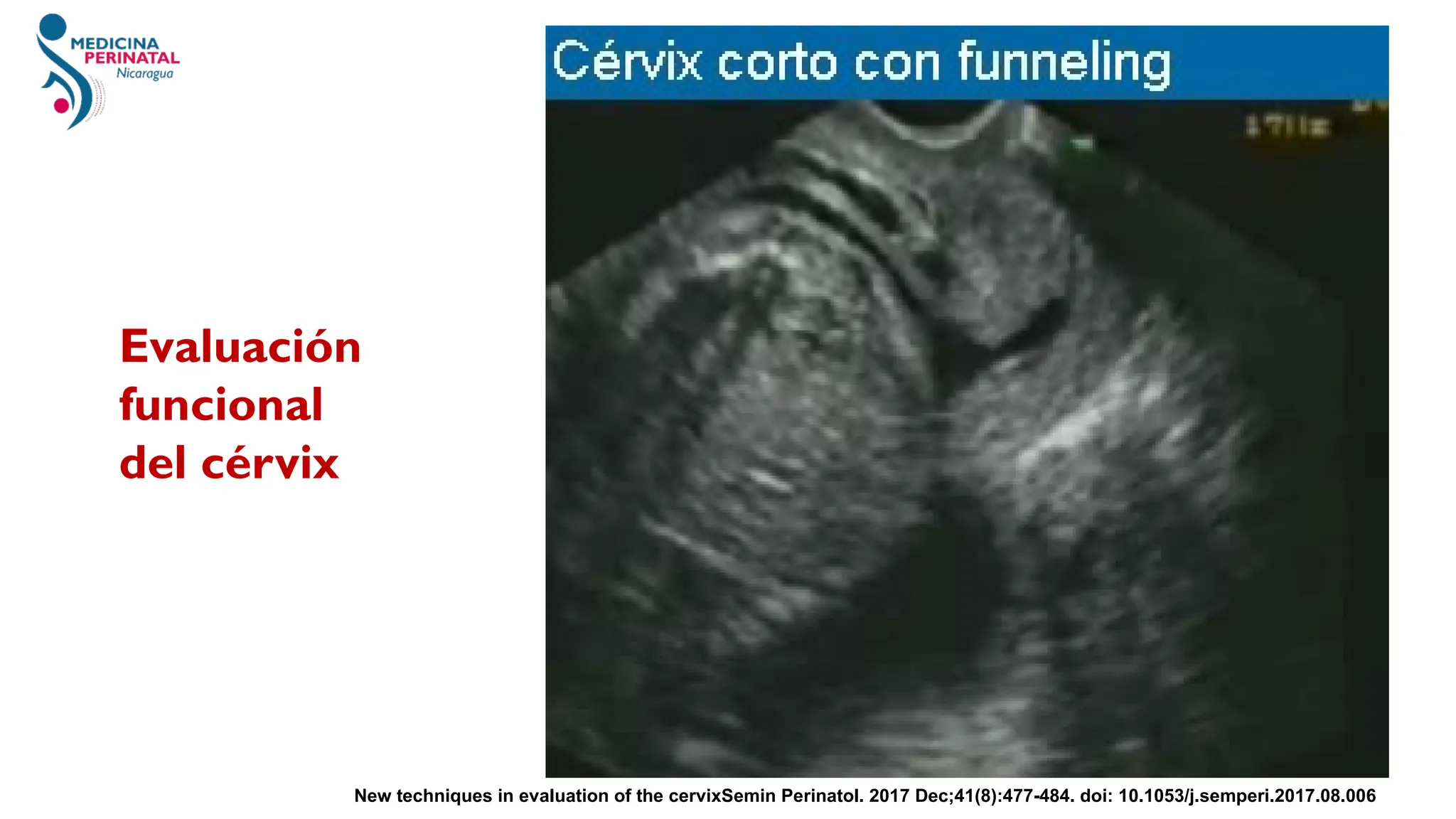 Cervicometría o longitud cervical examen radiologico de importancia en ...