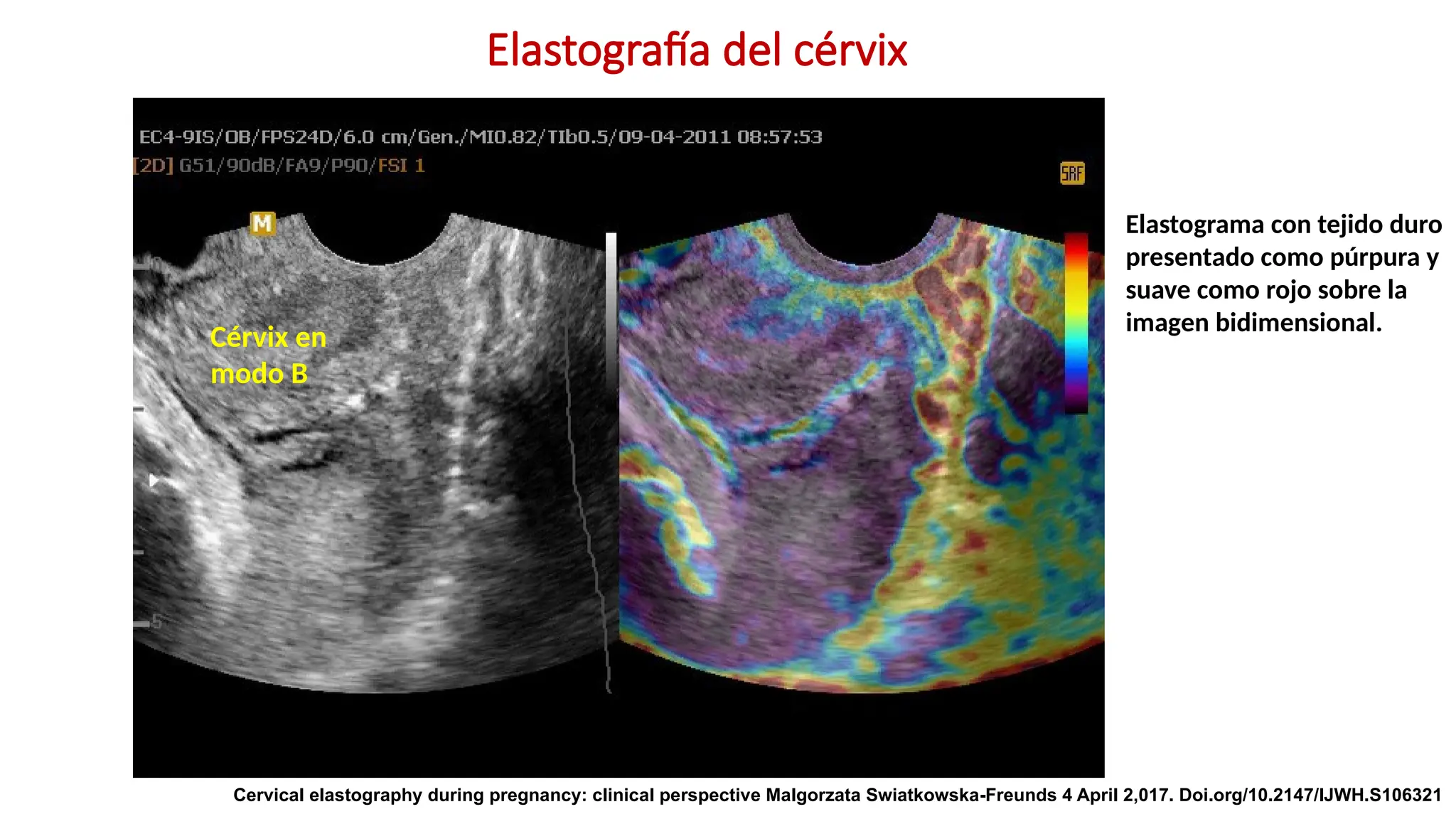 Cervicometría o longitud cervical examen radiologico de importancia en ...