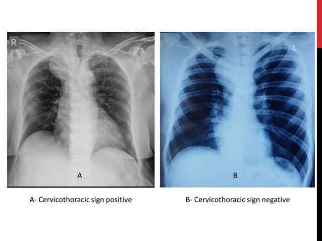 Cervicothoracic sign.pptx