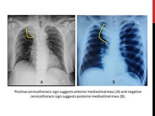 Cervicothoracic sign.pptx