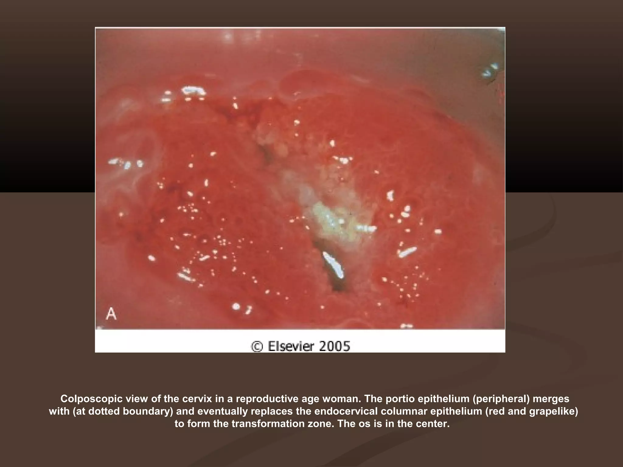 PATHOLOGY OF THE CERVIX | PPT