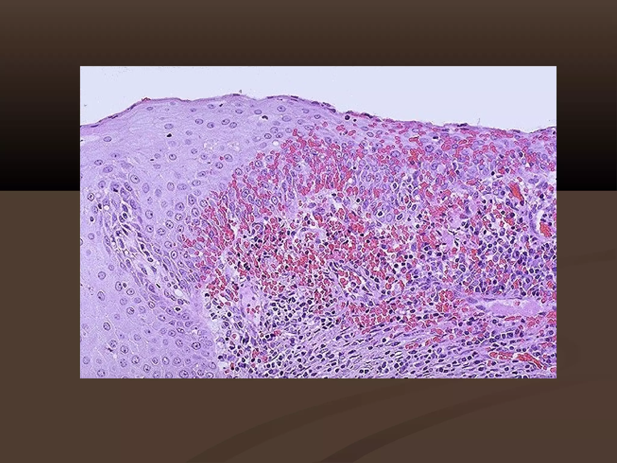Pathology Of The Cervix Ppt