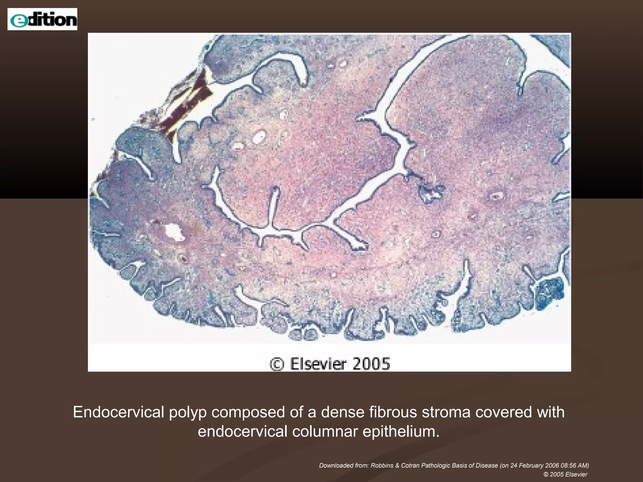 PATHOLOGY OF THE CERVIX | PPT