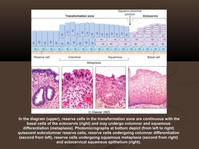 PATHOLOGY OF THE CERVIX | PPT | Reproductive Health | Diseases and ...