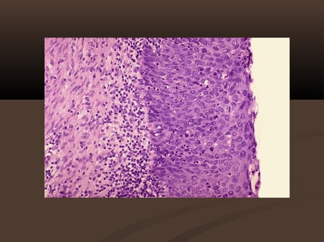 PATHOLOGY OF THE CERVIX | PPT | Reproductive Health | Diseases and ...