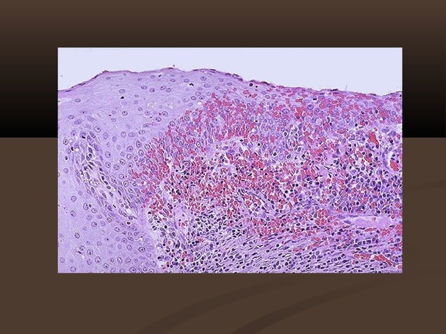 PATHOLOGY OF THE CERVIX | PPT | Reproductive Health | Diseases and ...