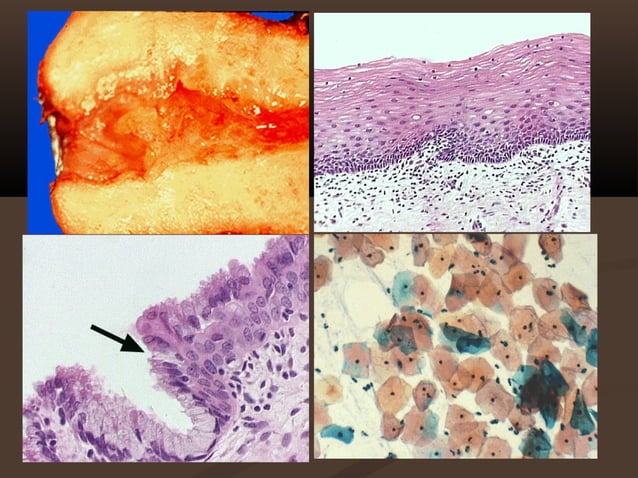 PATHOLOGY OF THE CERVIX | PPT | Reproductive Health | Diseases and ...
