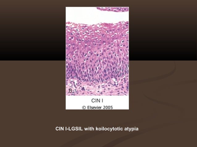 PATHOLOGY OF THE CERVIX | PPT | Reproductive Health | Diseases and ...