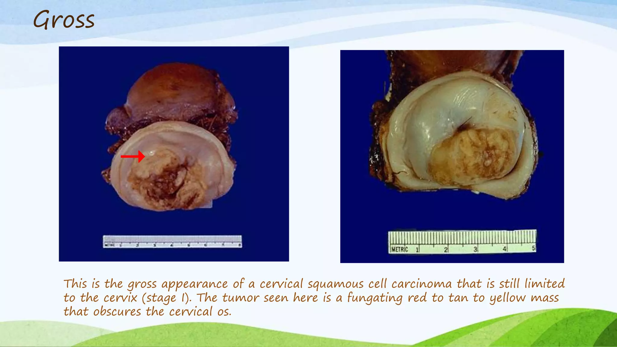 Cervix - 2nd year UG | PPTX