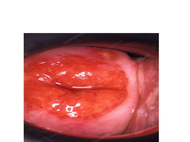 benign lesion of Cervix describing .pptx