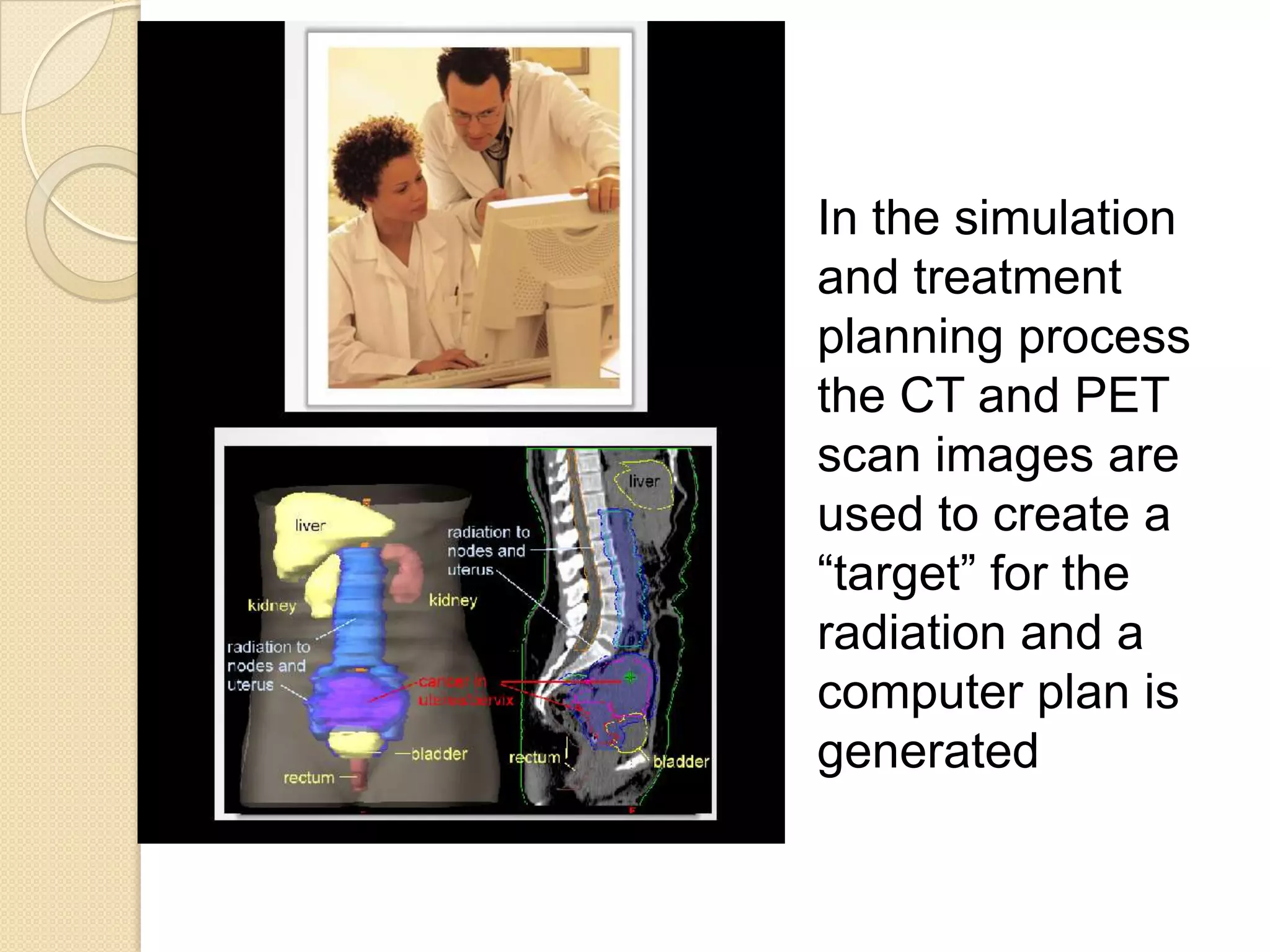 Radiation for Cervix Cancer | PPTX