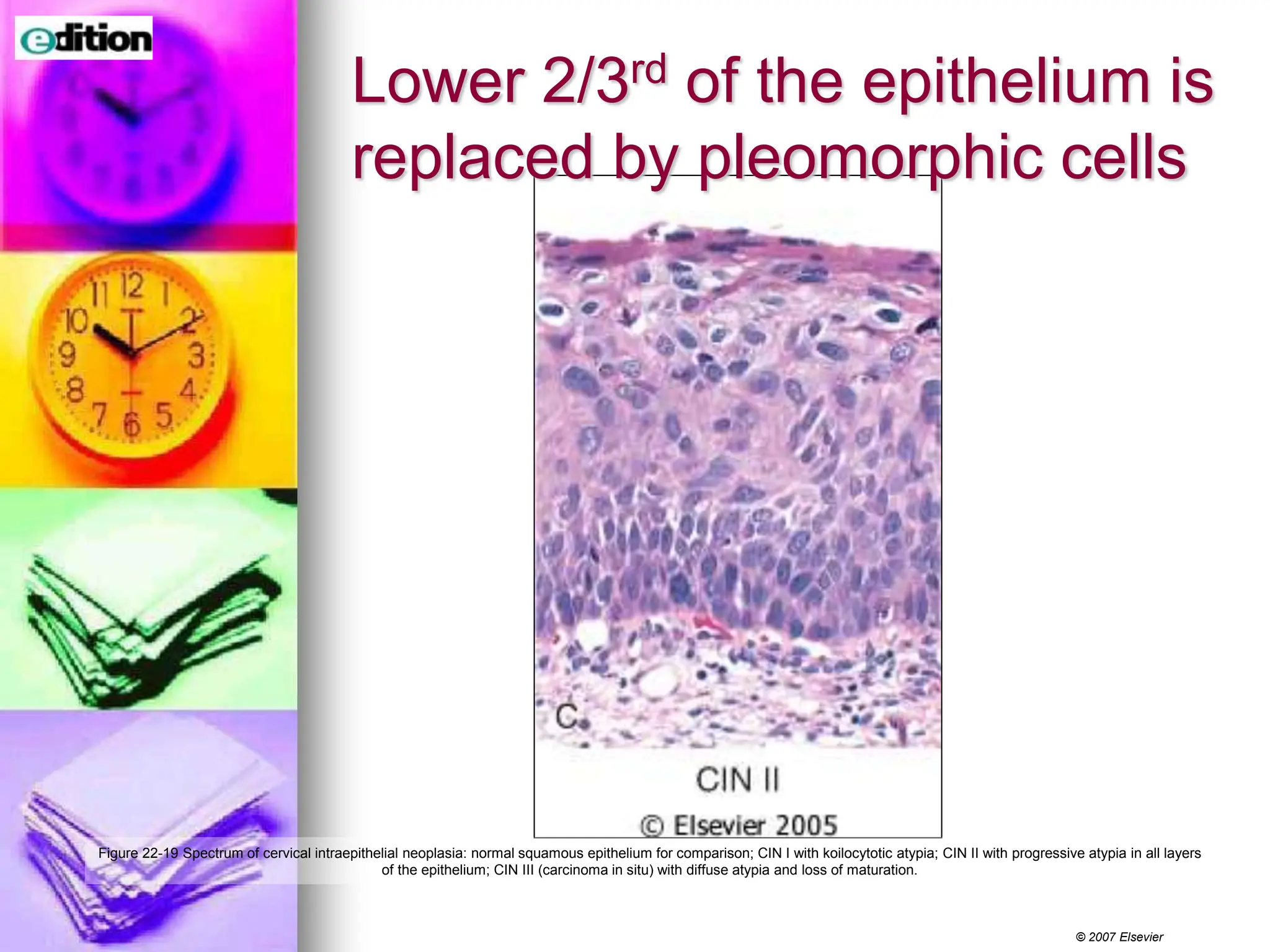 Cervix Carcinoma Cervix Carcinoma Cervix Carcinoma.ppt | Cancer ...