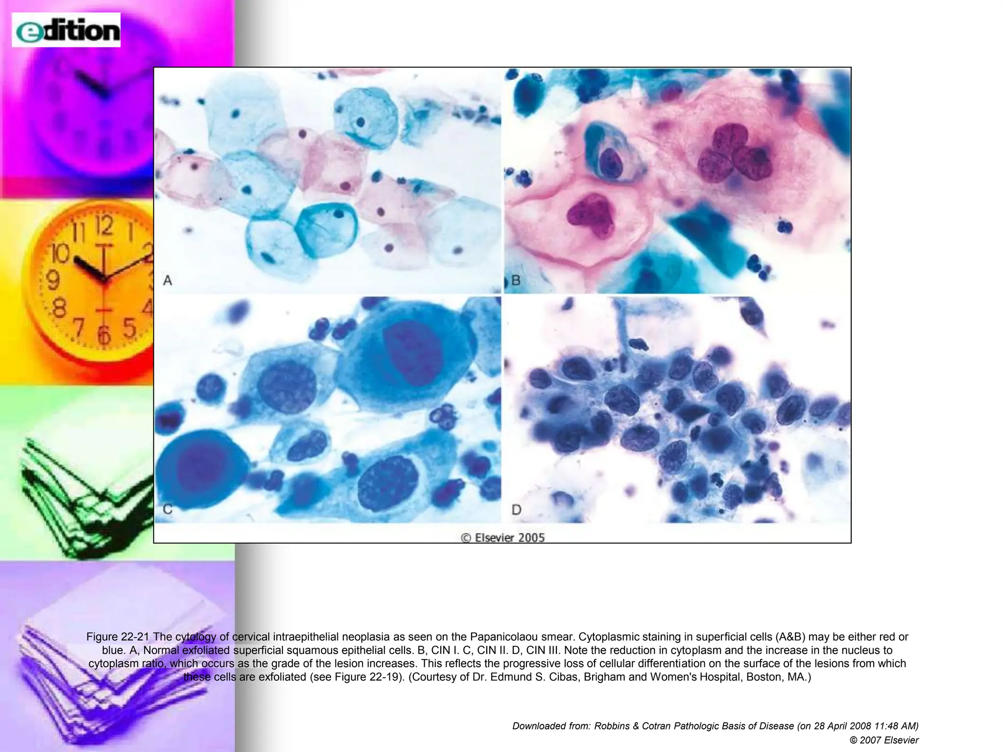 Cervix Carcinoma Cervix Carcinoma Cervix Carcinoma.ppt | Cancer ...