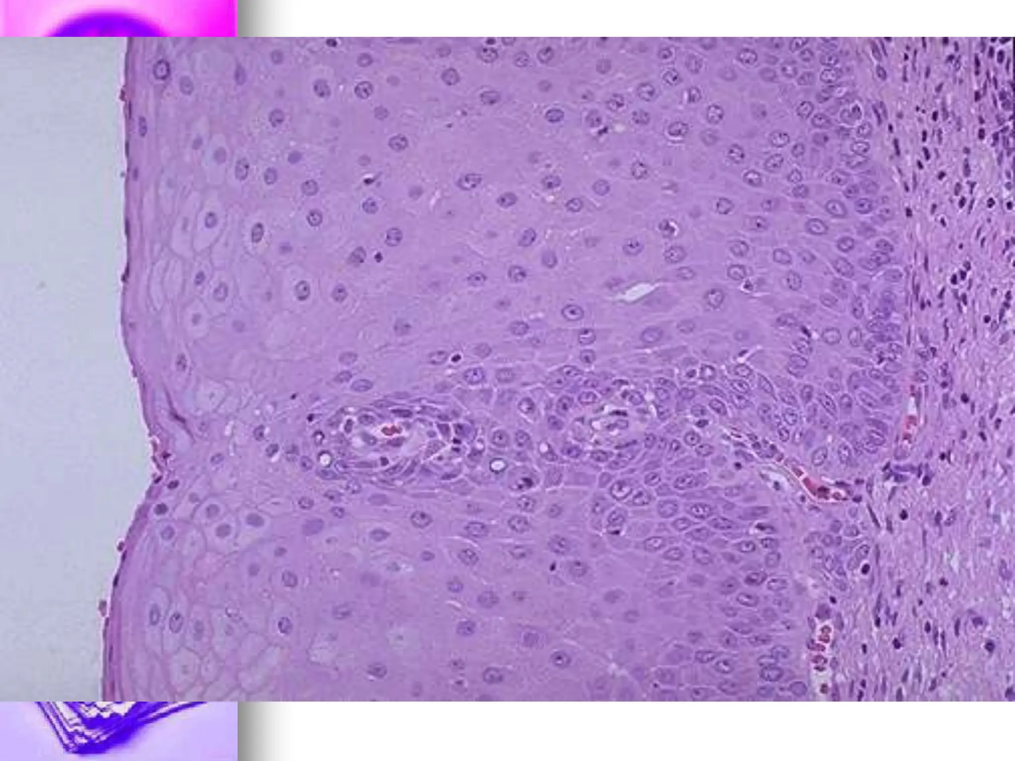 Cervix Carcinoma Cervix Carcinoma Cervix Carcinoma.ppt | Cancer ...