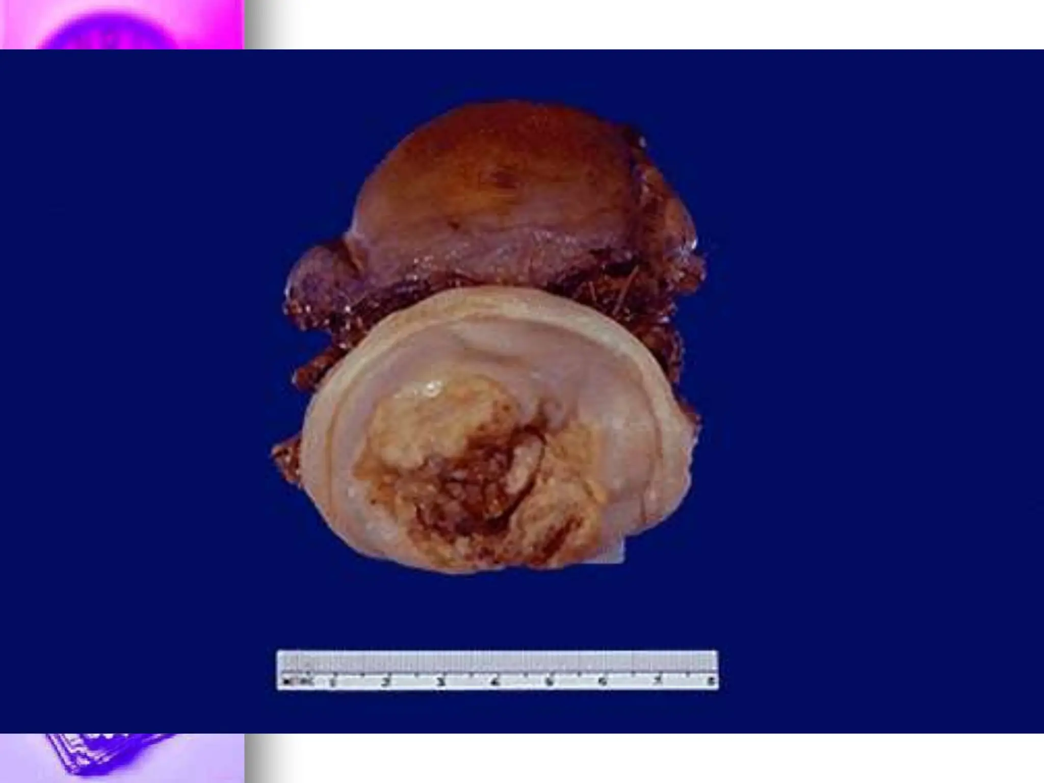 Cervix Carcinoma Cervix Carcinoma Cervix Carcinoma.ppt | Cancer ...