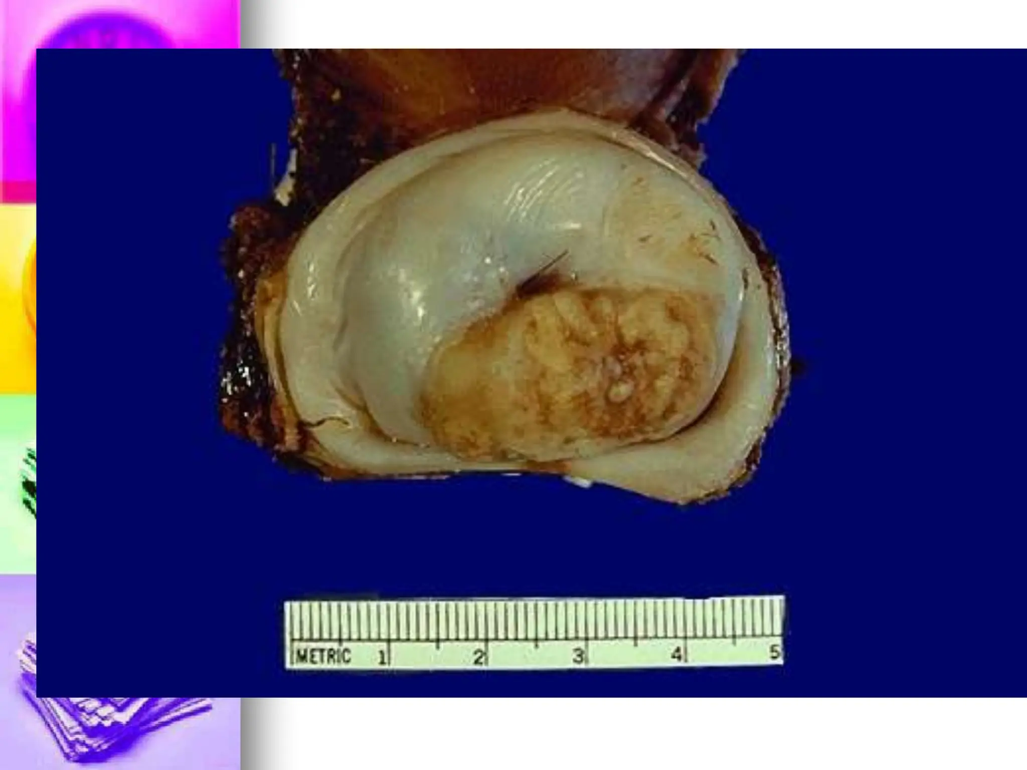 Cervix Carcinoma Cervix Carcinoma Cervix Carcinoma.ppt | Cancer ...