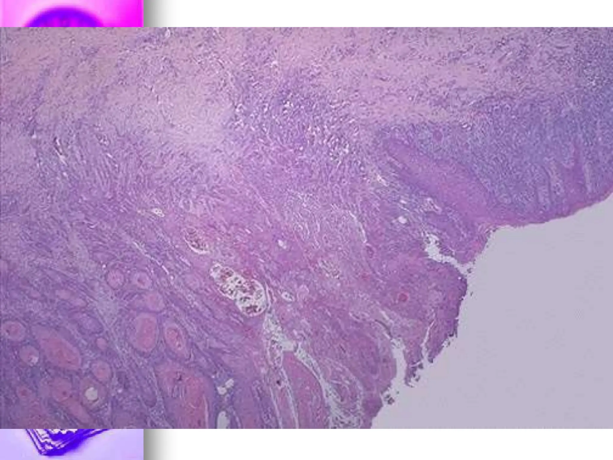 Cervix Carcinoma Cervix Carcinoma Cervix Carcinoma.ppt | Cancer ...