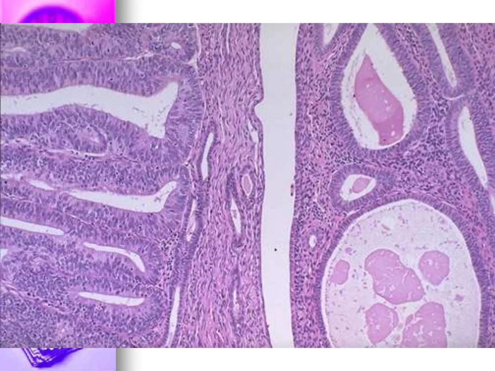 Cervix Carcinoma Cervix Carcinoma Cervix Carcinoma.ppt | Cancer ...