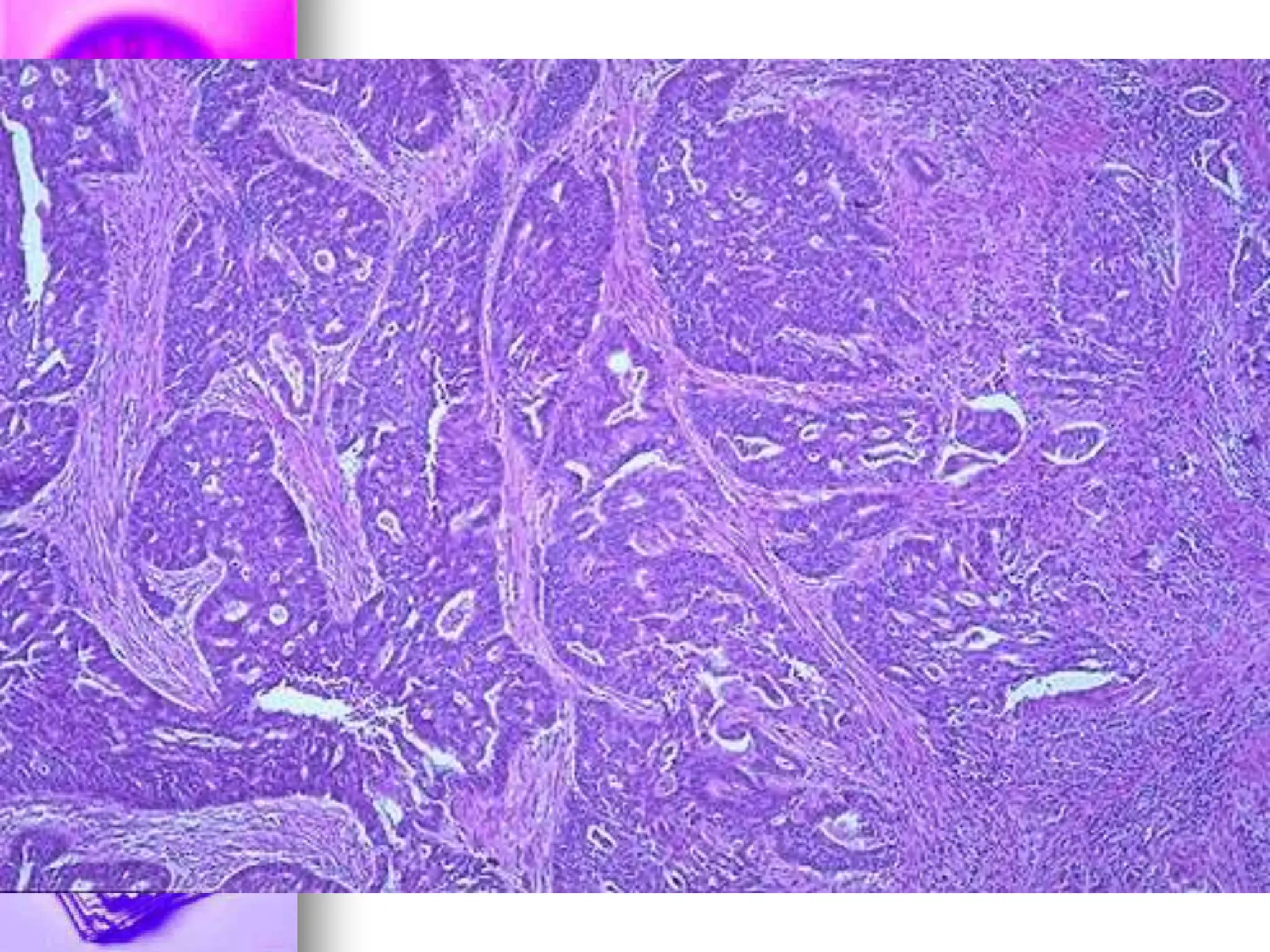 Cervix Carcinoma Cervix Carcinoma Cervix Carcinoma.ppt | Cancer ...