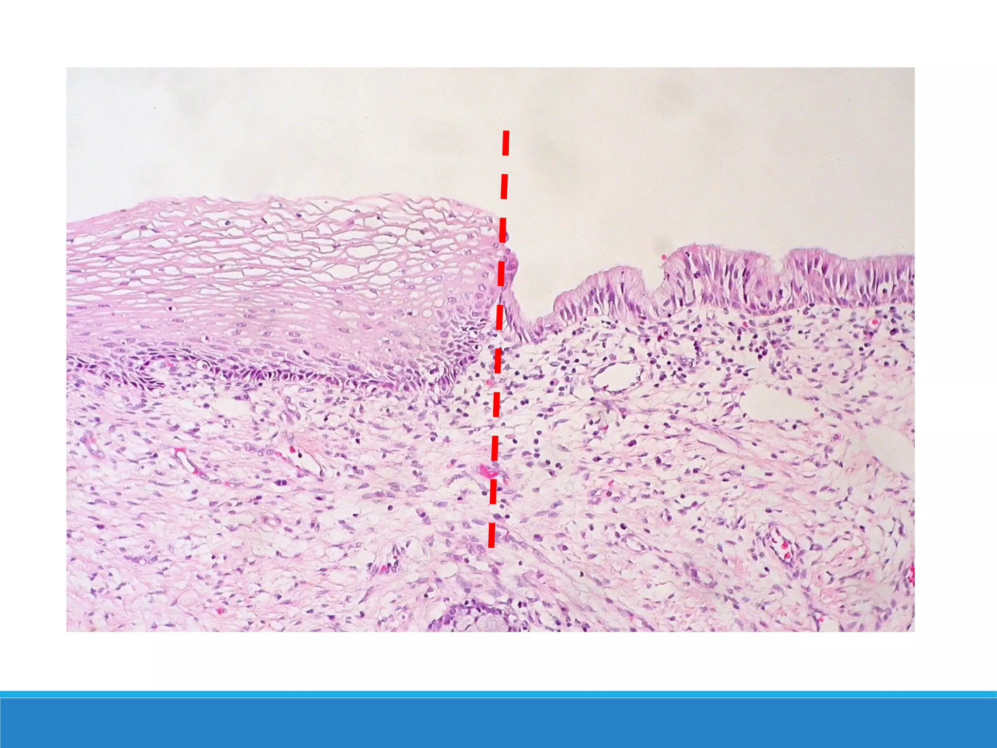 Pathology of Cervix | PPT