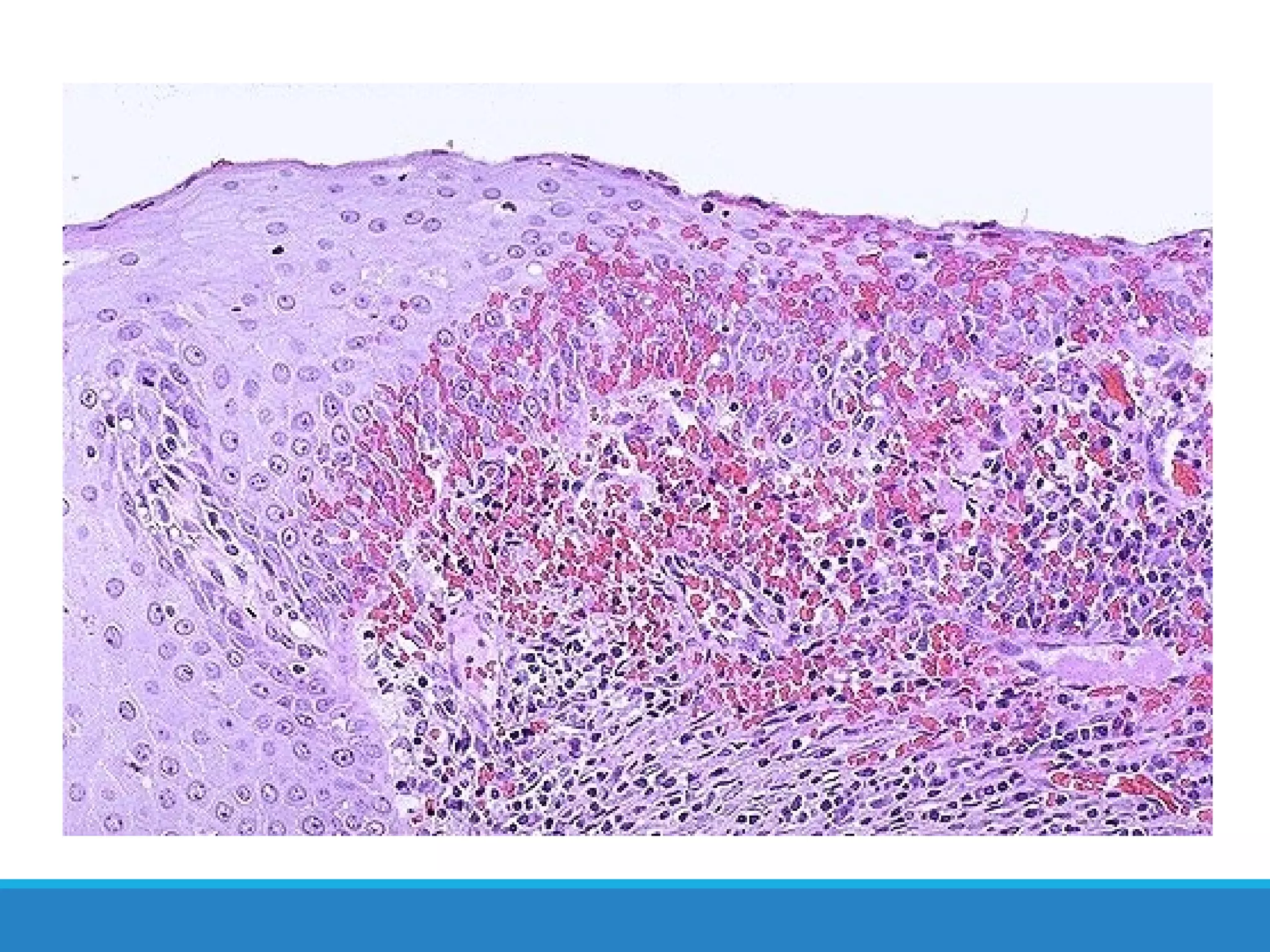 Pathology of Cervix | PPT