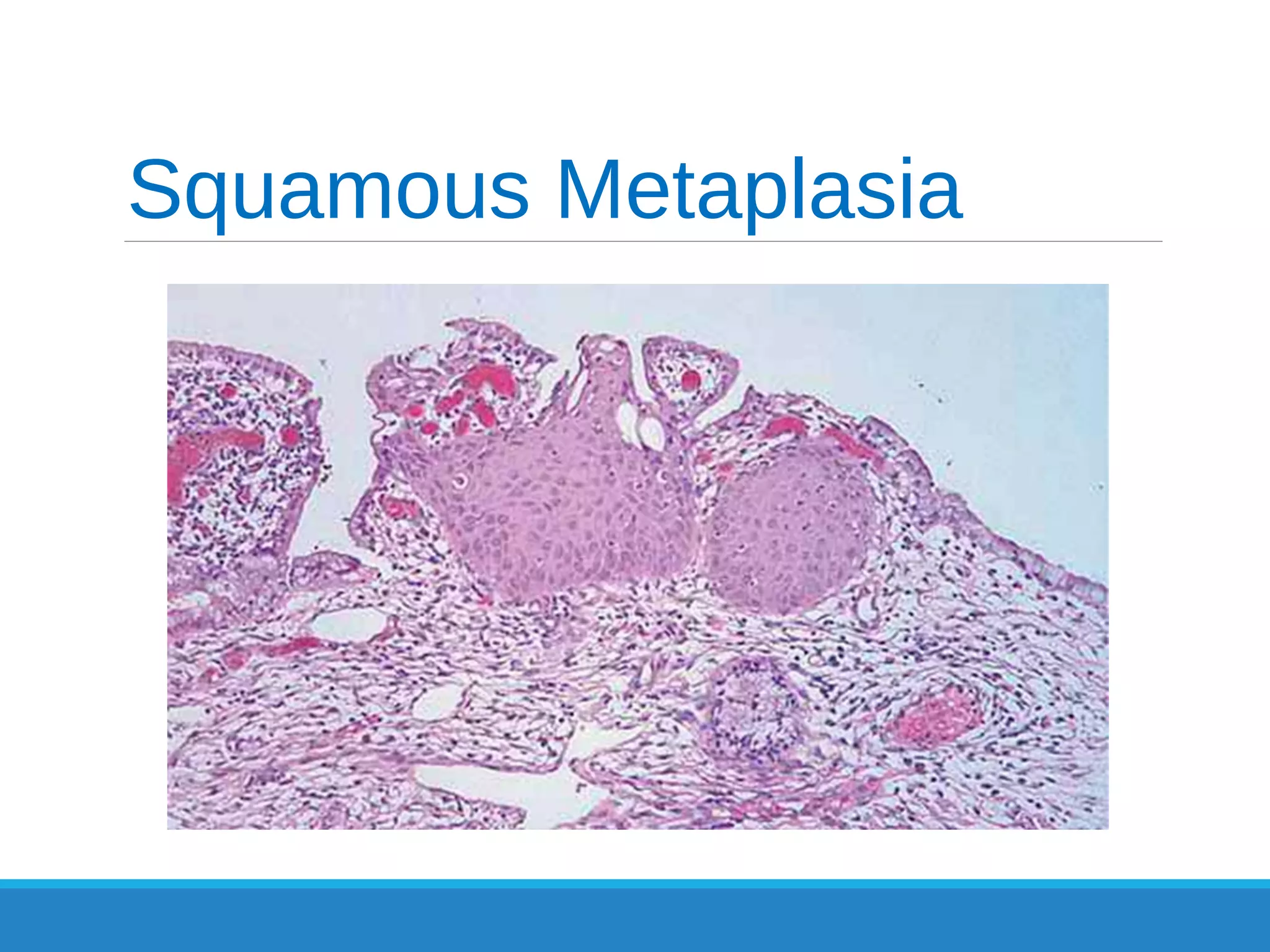 Pathology of Cervix | PPT
