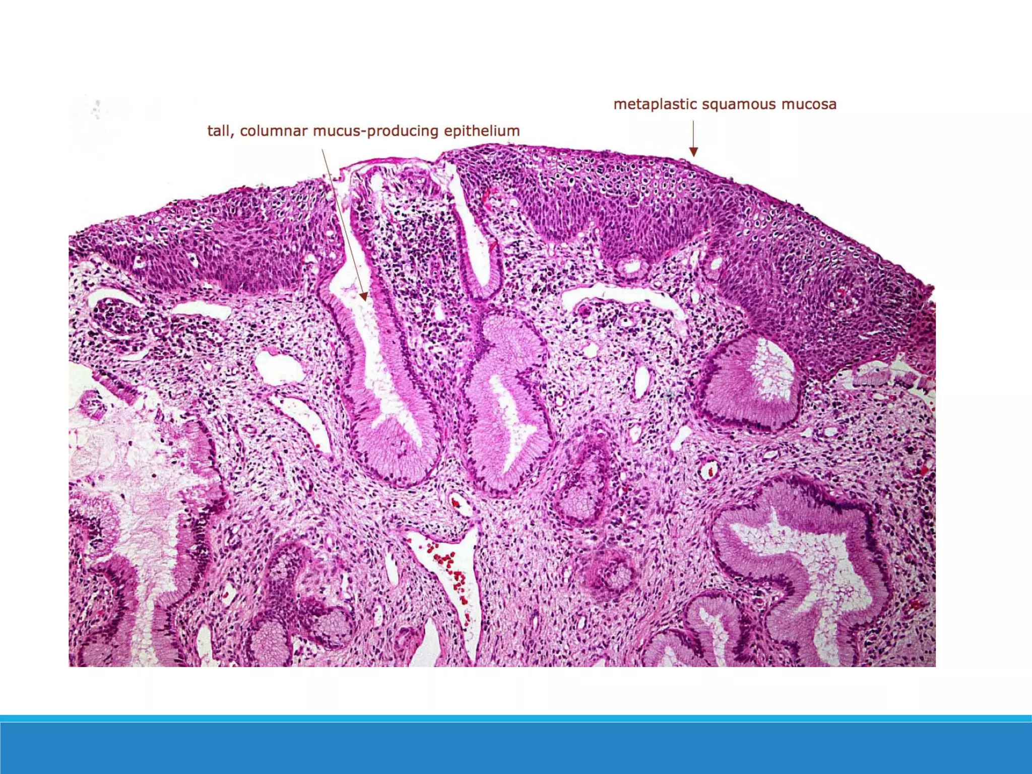 Pathology of Cervix | PPT