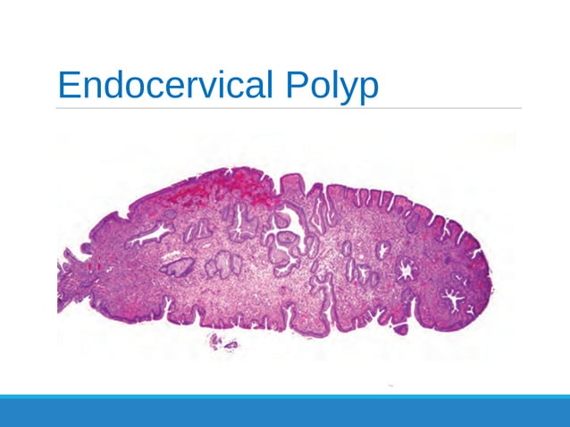 Pathology of Cervix | PPT