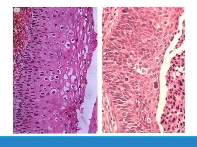 Pathology of Cervix | PPT