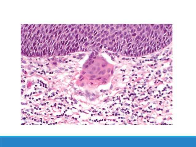 Pathology of Cervix | PPT