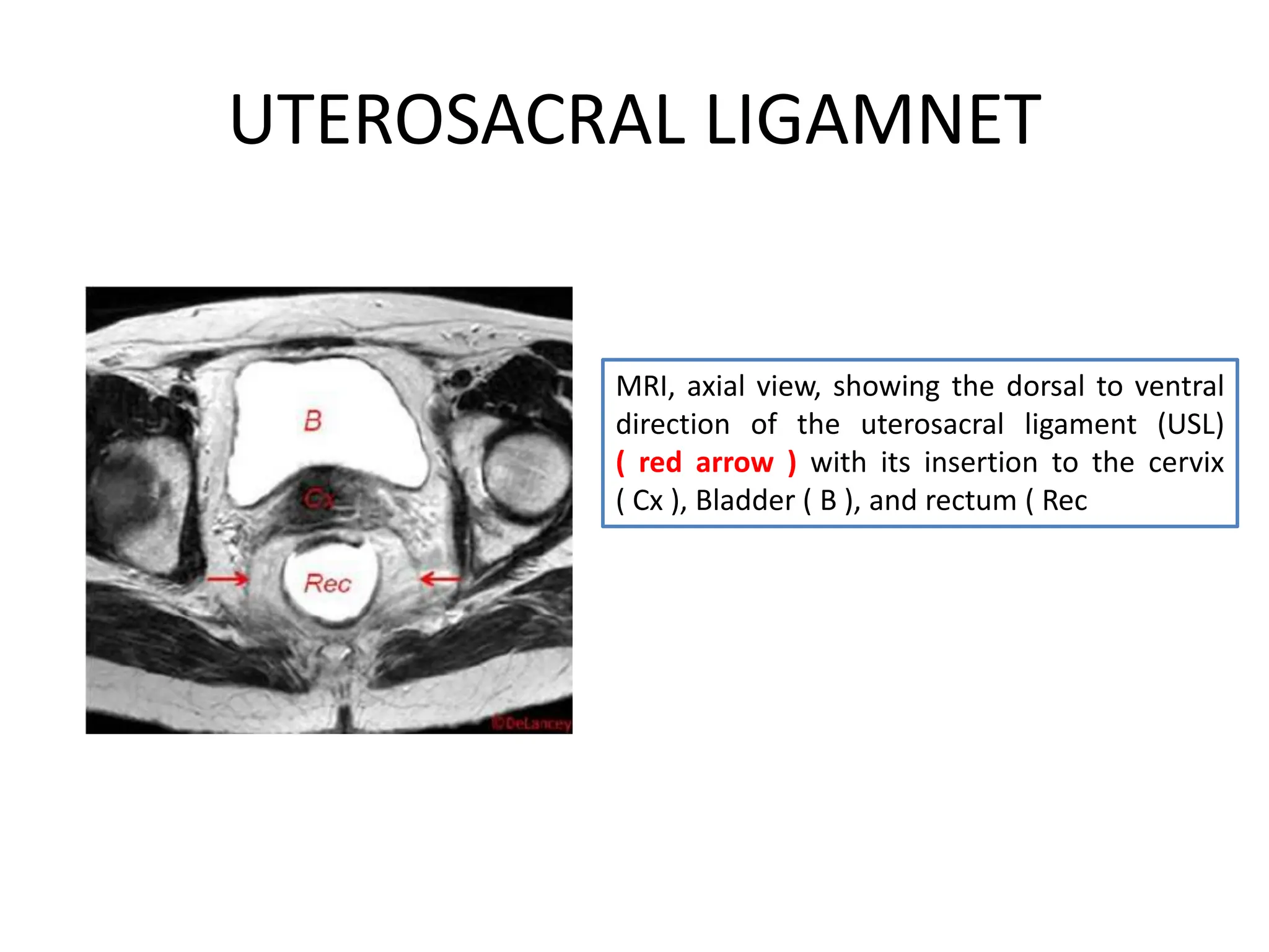 TARGET DELINEATION IN CERVIX CANCER BY DR KANHU | PPTX