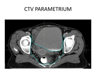 TARGET DELINEATION IN CERVIX CANCER BY DR KANHU | PPTX
