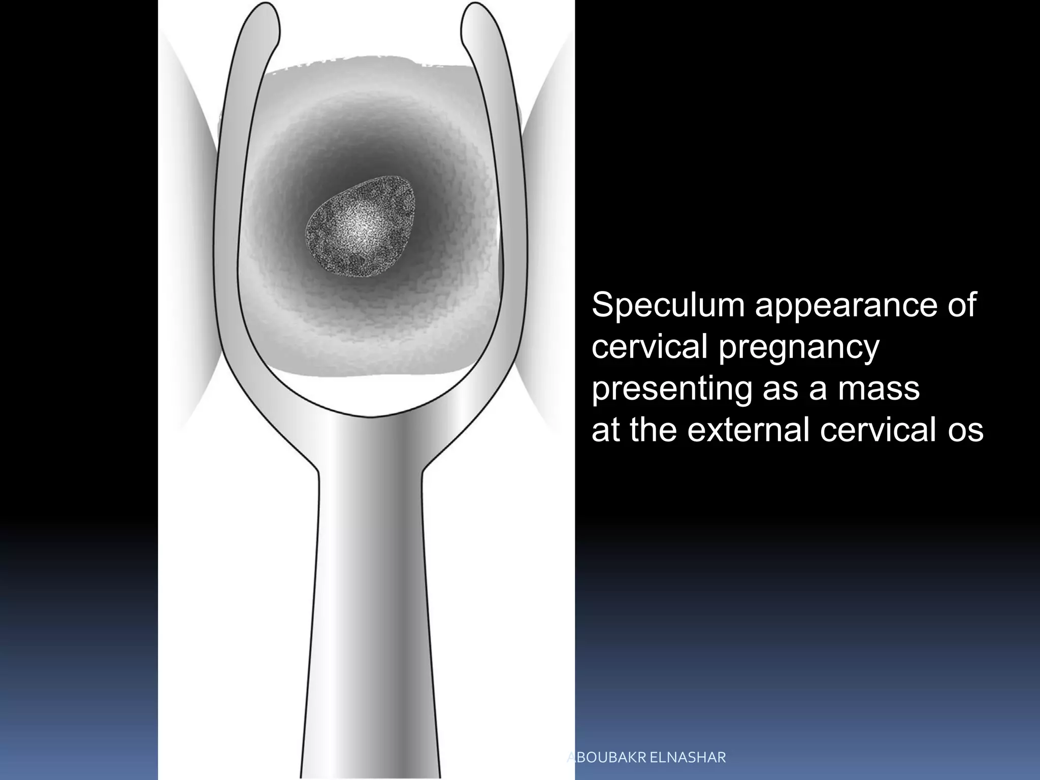 Cervical pregnancy | PDF