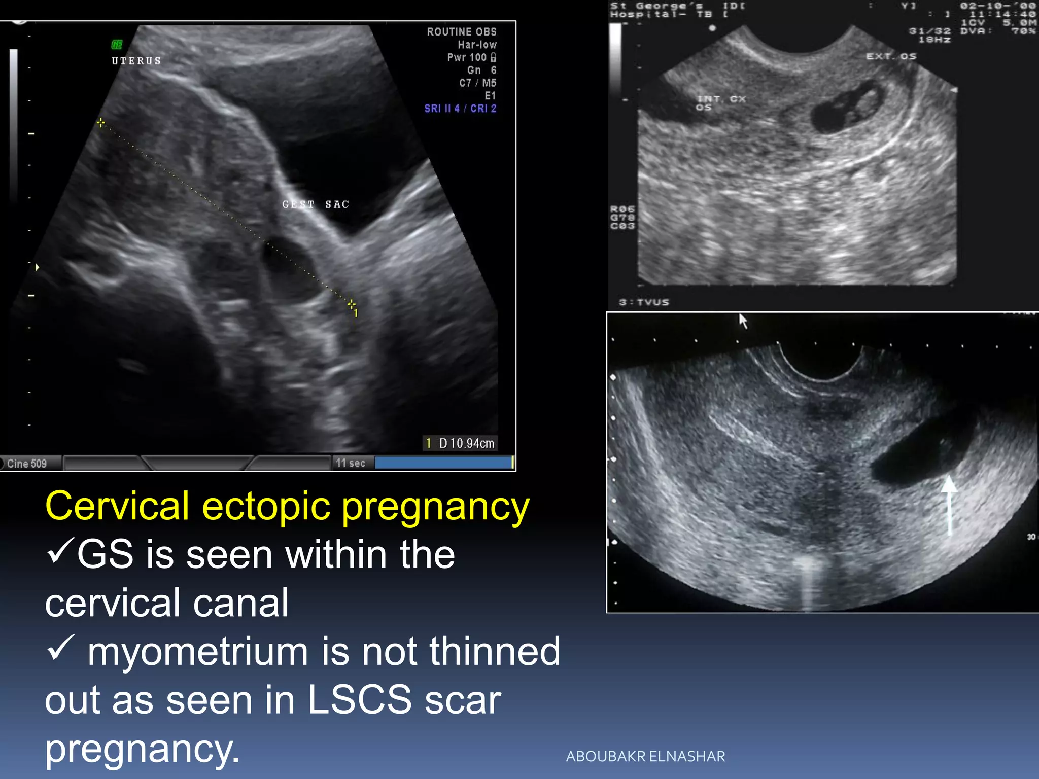 Cervical pregnancy | PDF