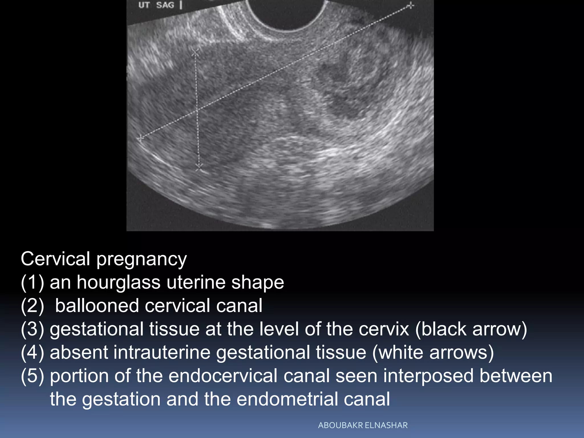 Cervical pregnancy | PDF