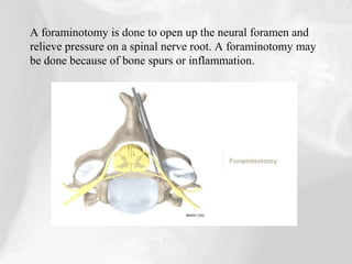 Cervical Spondylosis | PPT