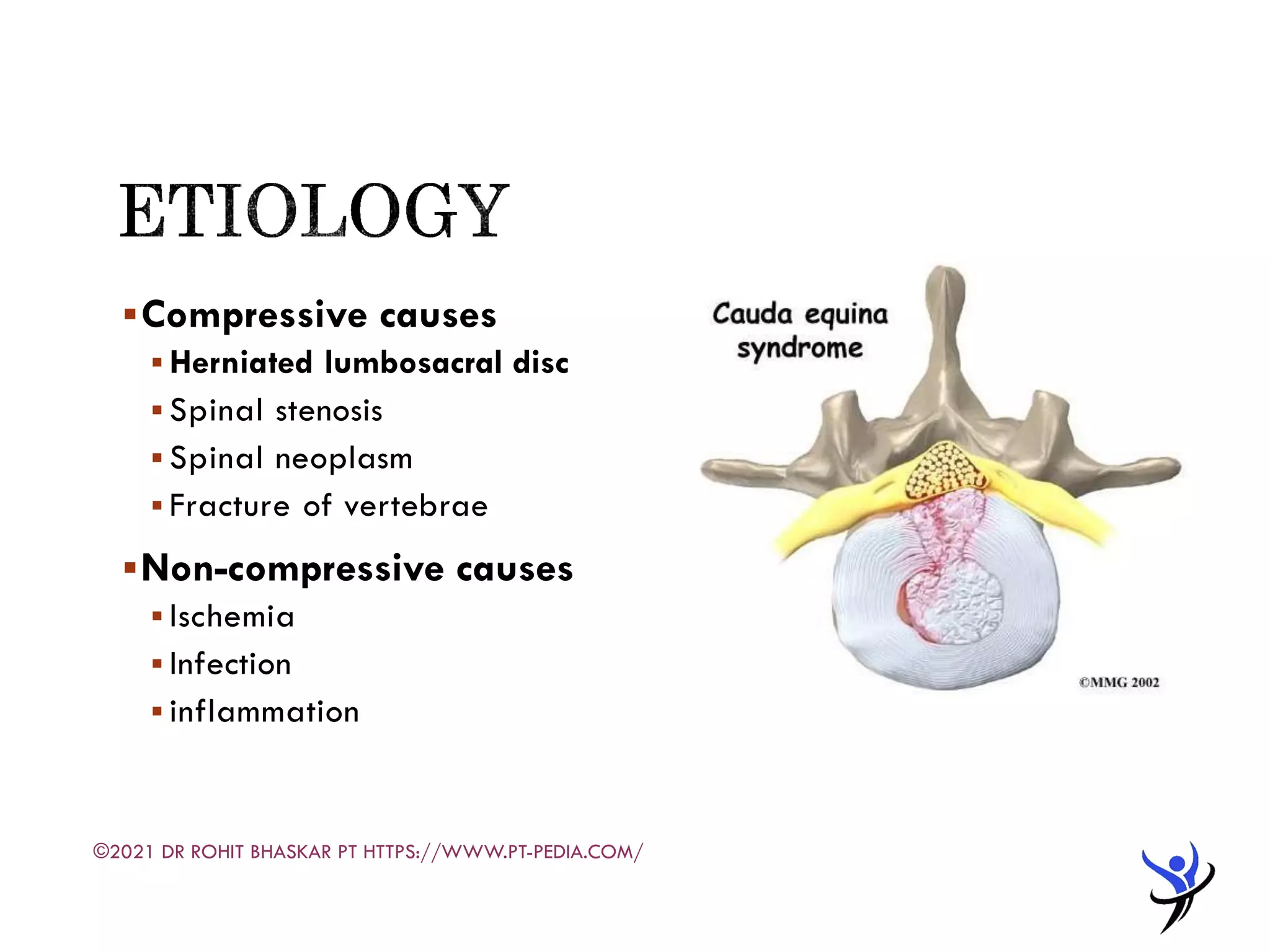 Cauda Equina Syndrome - Dr Rohit Bhaskar | PDF