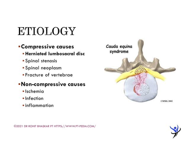 Cauda Equina Syndrome - Dr Rohit Bhaskar | PDF | Brain and Nervous ...